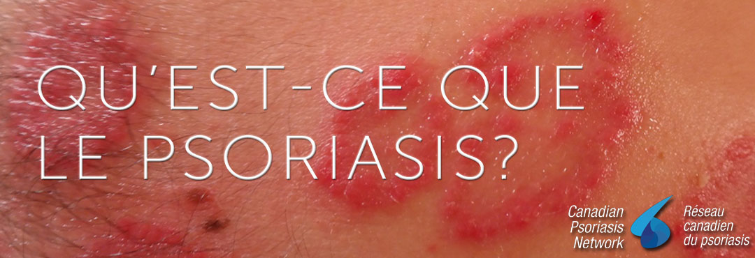 Accueil | Réseau canadien du psoriasis